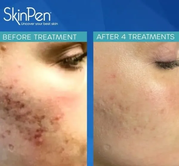 SkinPen Microneedling Treatment In Mason And Cincinnati, OH